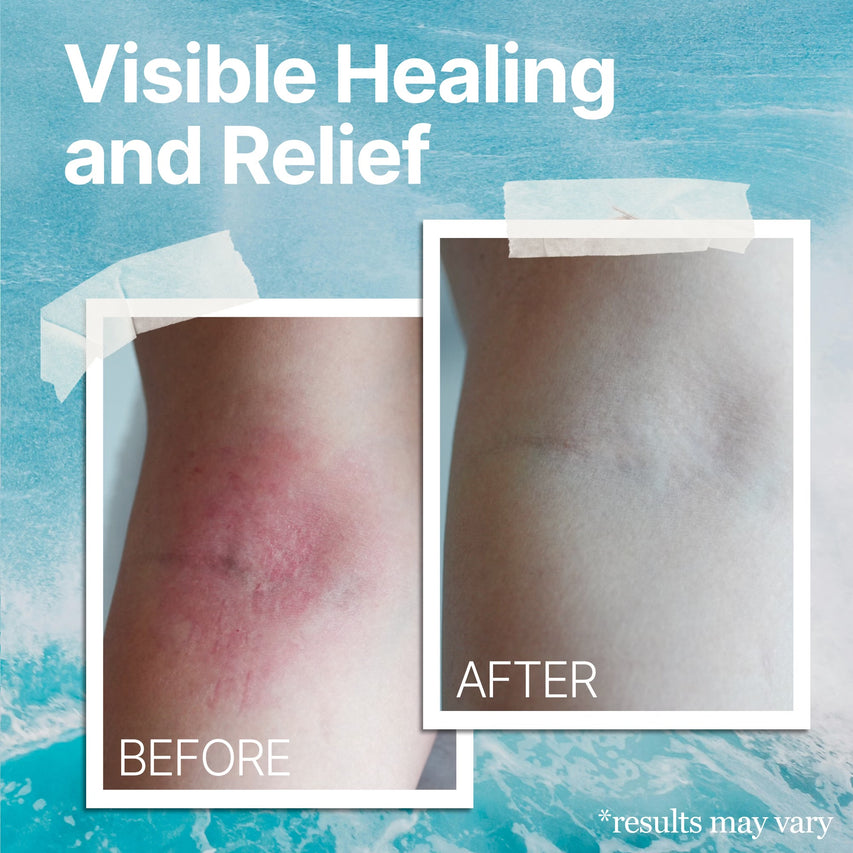 The Ocean Healed My Eczema - Soothing Cream – HealedByTheOcean